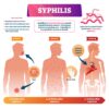 Management of syphilis in pregnancy – Medisprep
