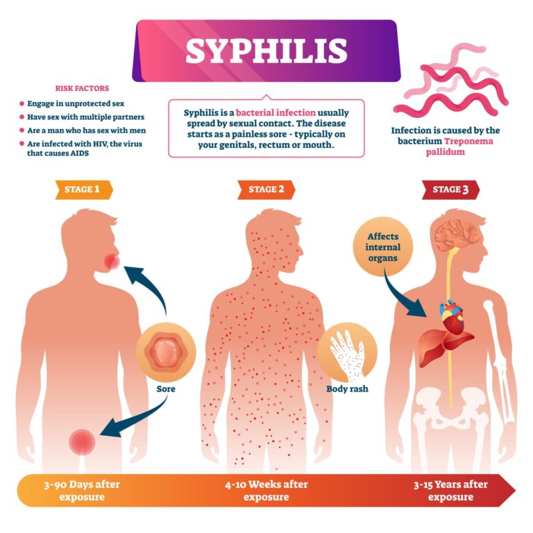 Management of syphilis in pregnancy – Medisprep